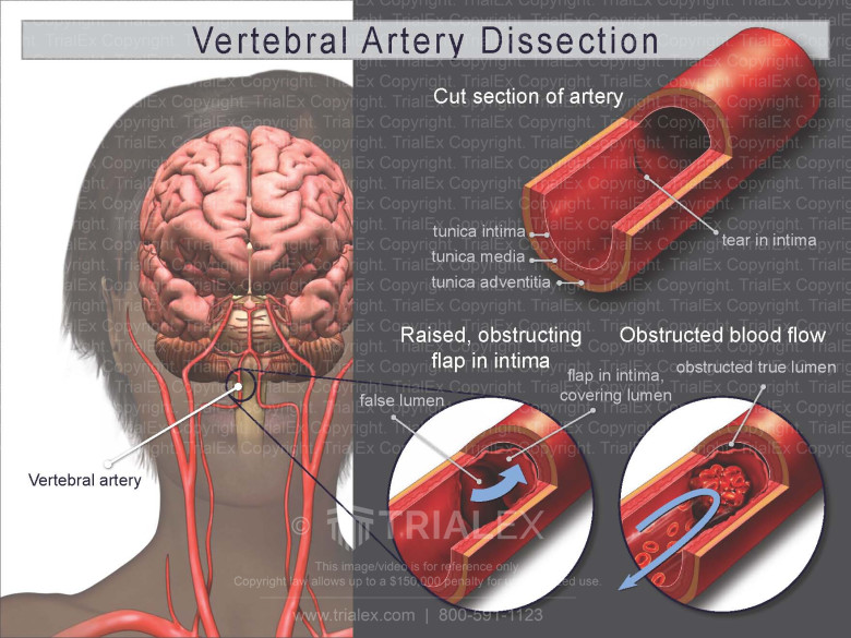 Vertebral Artery Dissection TrialQuest Inc 