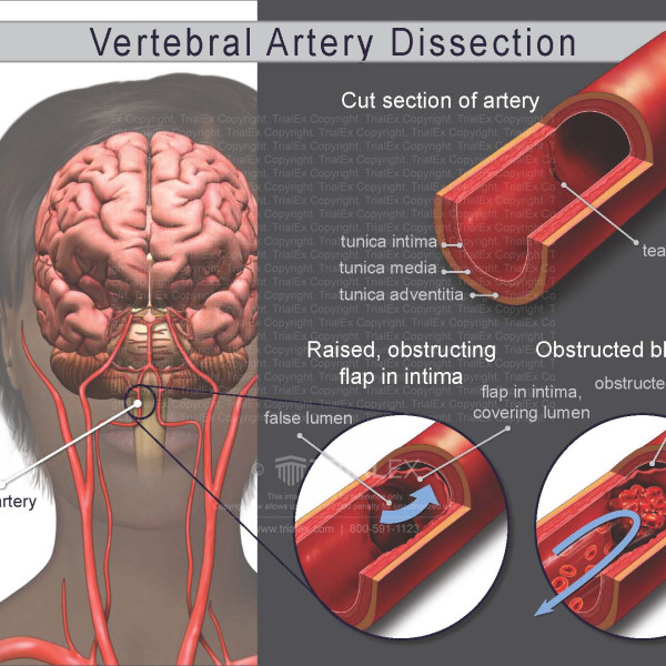 Medical Legal Exhibits Legal Animations Trial Graphics Tria 