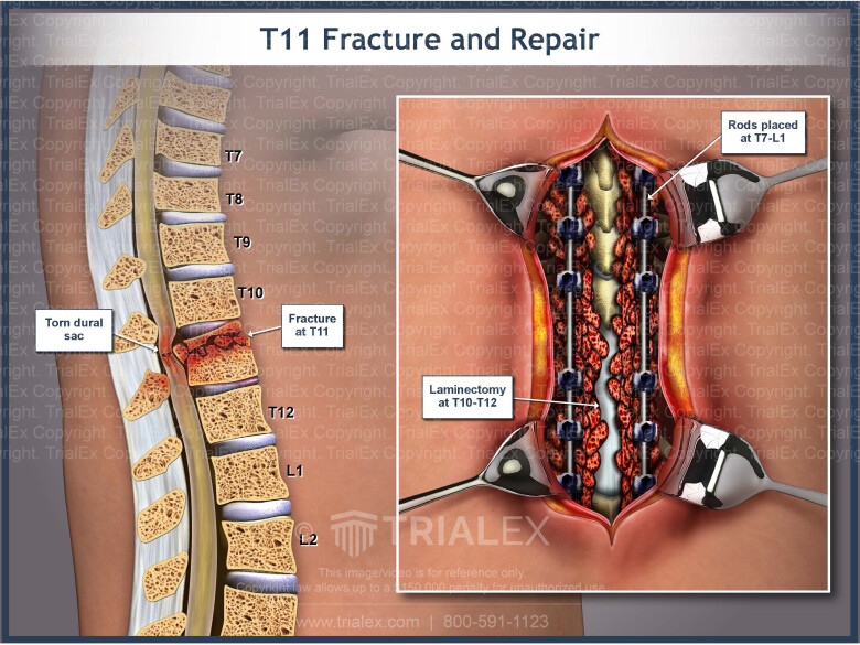 T11 Fracture And Repair TrialQuest Inc T11 Fracture And Repair TrialQuest Inc