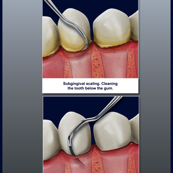 Subgingival Scaling