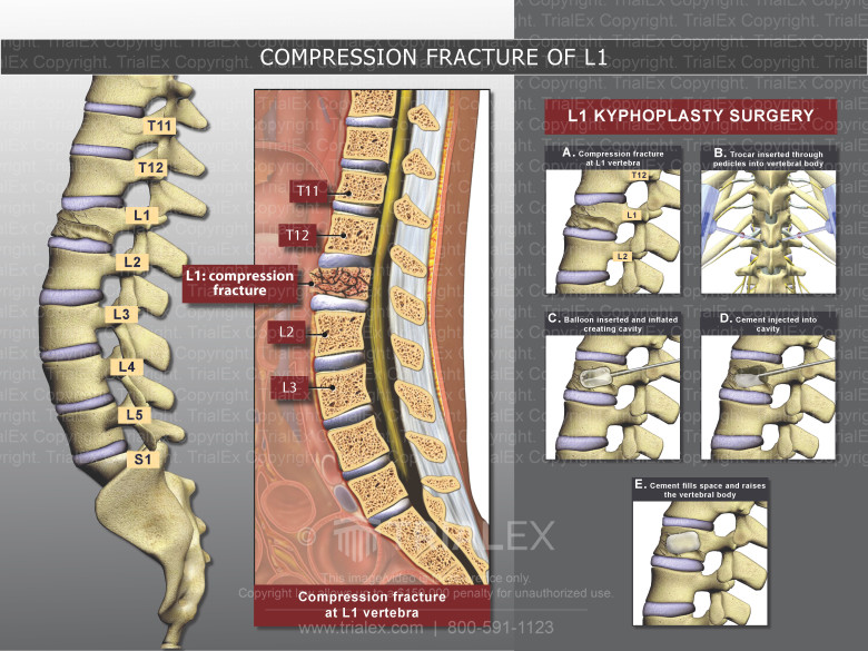 Compression Fracture Of L1