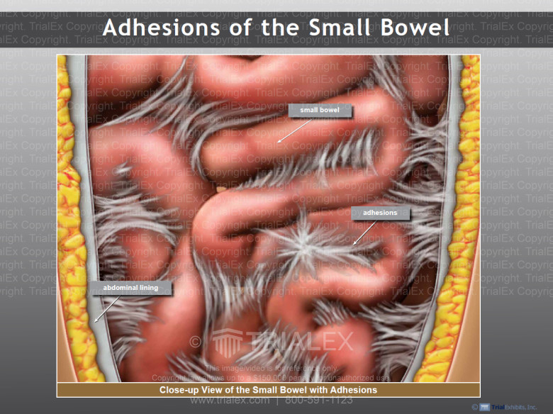 Adhesions Of The Small Bowel TrialQuest Inc 