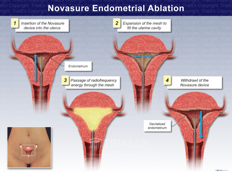 Novasure Endometrial Ablation TrialQuest Inc Novasure Endometrial Ablation TrialQuest Inc