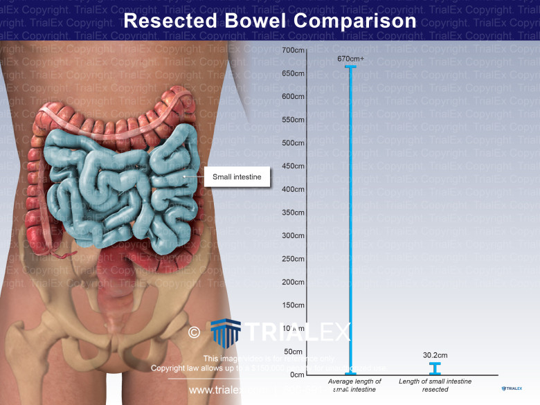 Resected Bowel Comparison