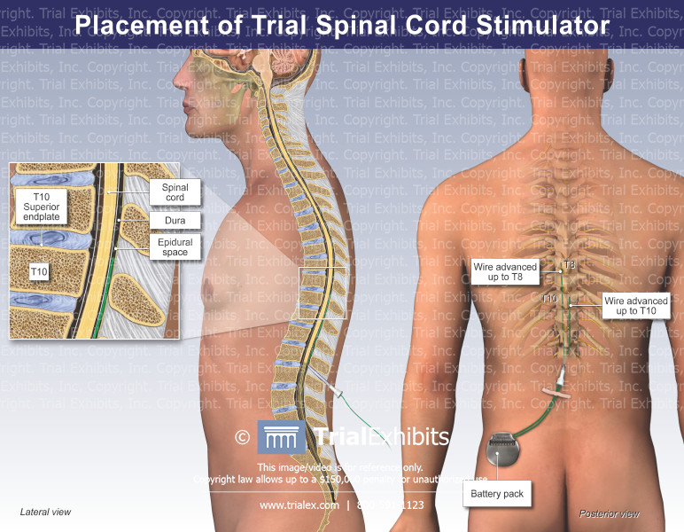 Spinal Cord Stimulation SCS Treatments Twin Cities Pain Clinic Jukkis Spinal Cord Stimulation SCS Treatments Twin Cities Pain Clinic Jukkis