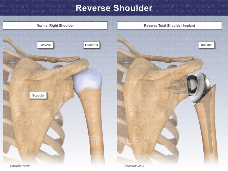 Reverse Shoulder Reverse Shoulder