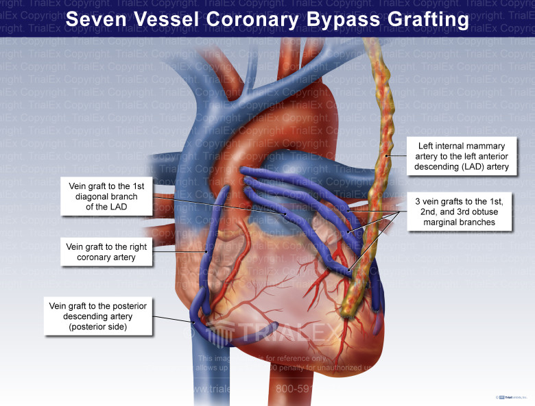 Seven Vessel Coronary Bypass Grafting Trial Exhibits Inc Seven Vessel Coronary Bypass Grafting Trial Exhibits Inc