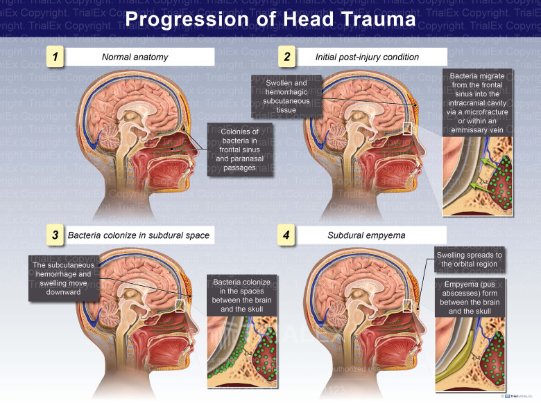 Progression Of Head Trauma TrialQuest Inc Progression Of Head Trauma TrialQuest Inc