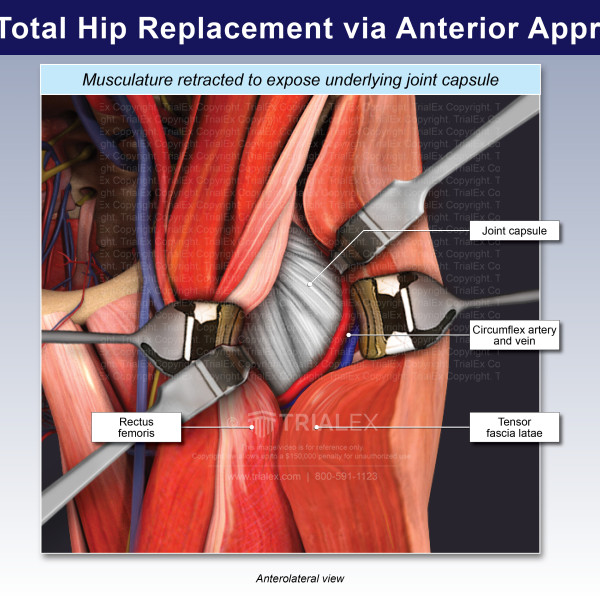 Medical Legal Exhibits Legal Animations Trial Graphics Tria 