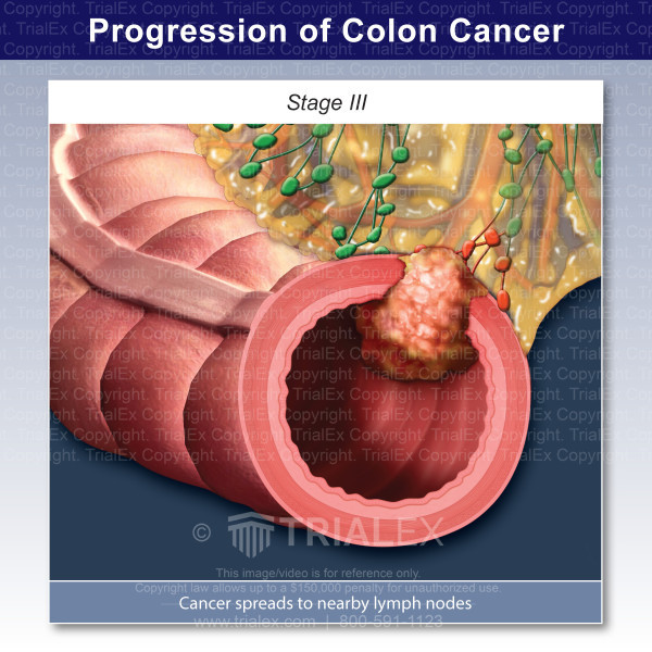 Progression Of Colon Cancer Stage III TrialQuest Inc 