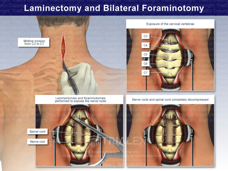 Laminectomy And Bilateral Foraminotomy Laminectomy And Bilateral Foraminotomy