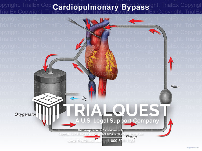 Cardiopulmonary Bypass TrialQuest Inc Cardiopulmonary Bypass TrialQuest Inc