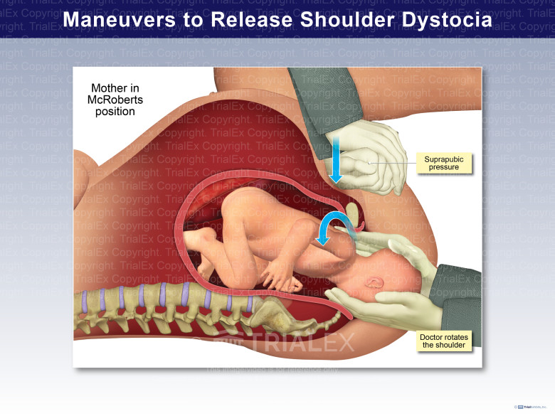 Suprapubic Pressure
