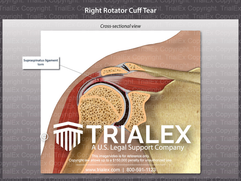 Right Rotator Cuff Tear Right Rotator Cuff Tear