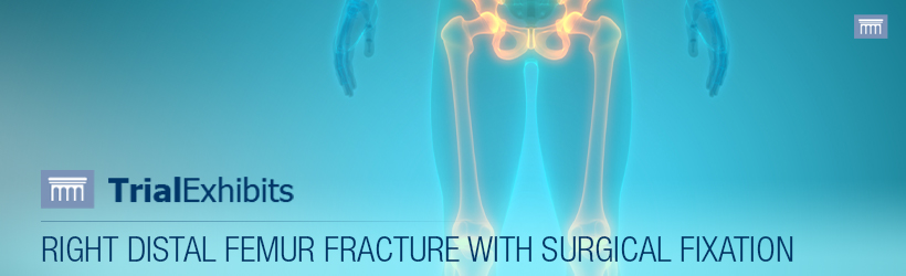 Right Distal Femur Fracture with Surgical Fixation