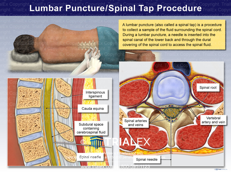 Lumbar Puncture Spinal Tap Procedure TrialQuest Inc 