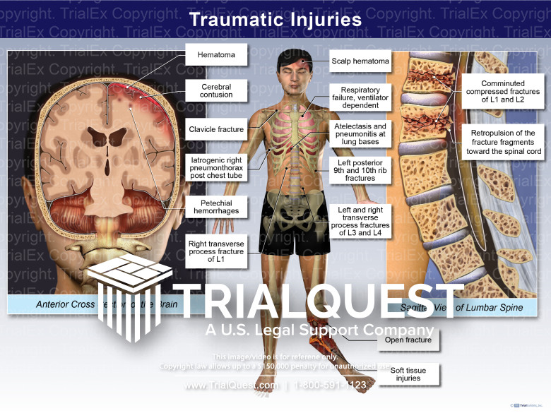 Traumatic Injuries TrialQuest Inc 