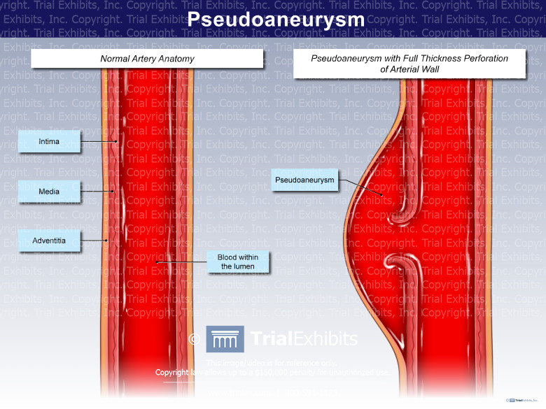 Pseudoaneurysm