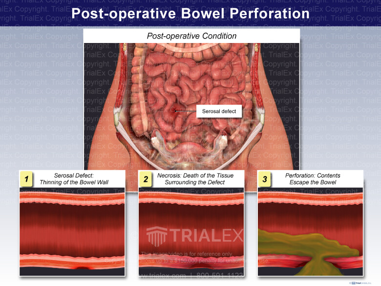 Post operative Bowel Perforation