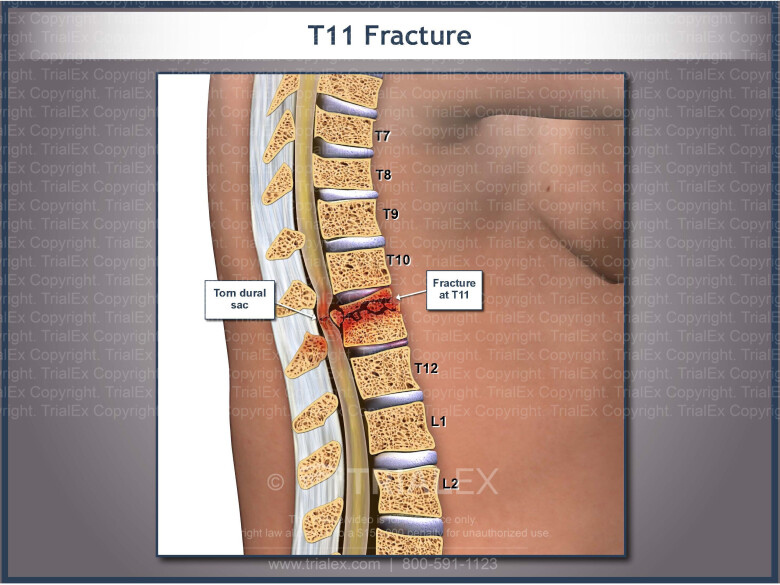 T11 Fracture TrialQuest Inc T11 Fracture TrialQuest Inc