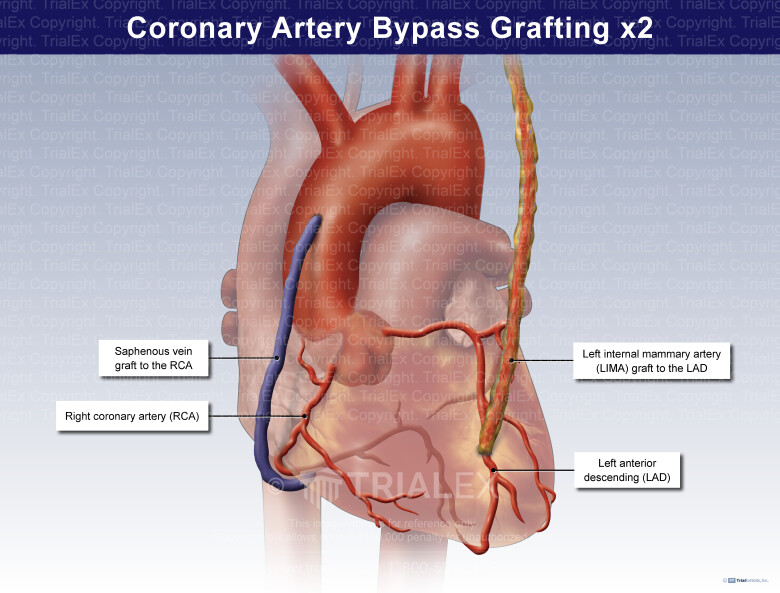 Coronary Artery Bypass Grafting X2 TrialQuest Inc 