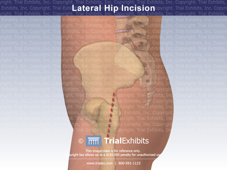 Lateral Hip Incision TrialQuest Inc Lateral Hip Incision TrialQuest Inc