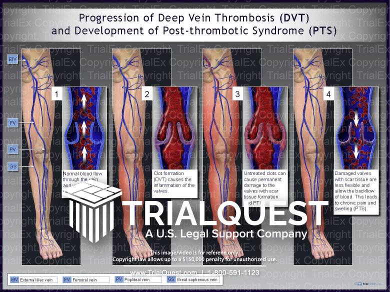 The Mechanism Of Deep Vein Thrombosis DVT And Pulmonary 48 OFF