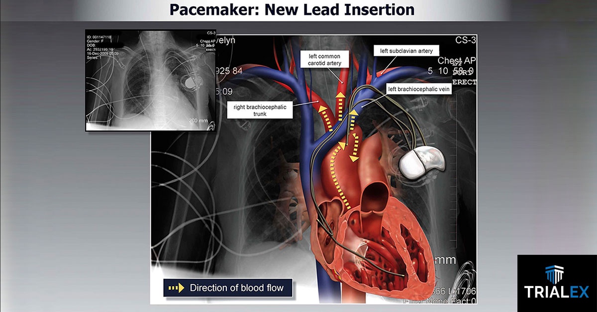 Pharmaceutical/ medical tool failures, impacts and recalls